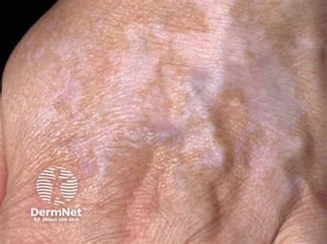 Vitiligo Images — Dermnet