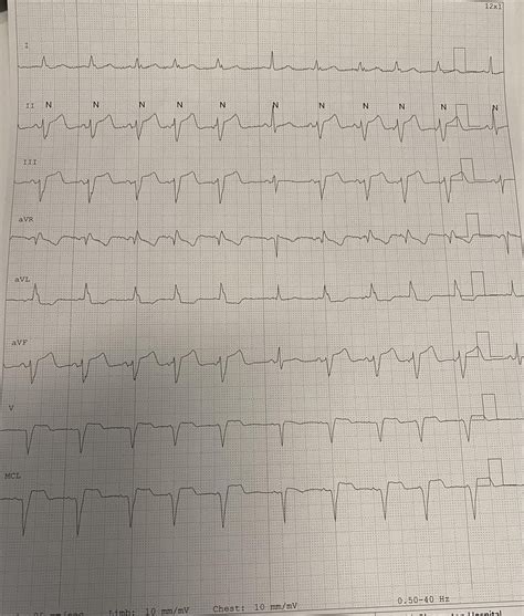 Intermittent Accel Junctional Ectopic Atrial With Aberrant Conduction
