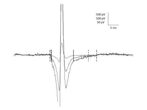 Motor Unit Action Potential Duration Measurement And Significance