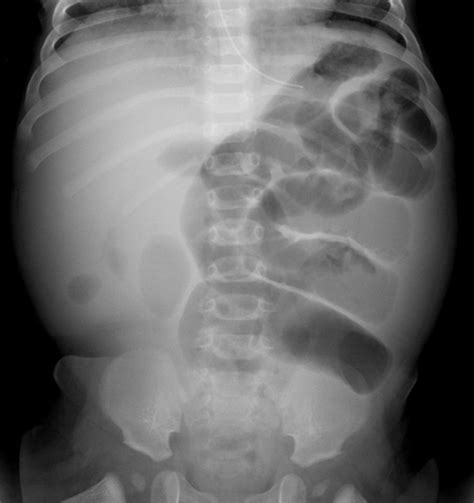 Intussusception X Ray Target Sign