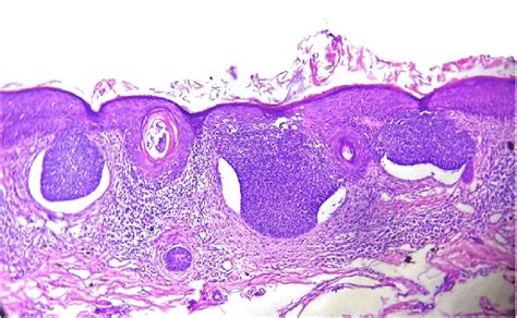 A Histopathology Picture Of A Nodular Bcc Showing Slightly Acanthotic Download Scientific