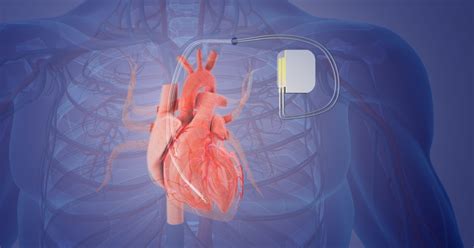 Advances In Pacemaker Technology A New Battery Free Design
