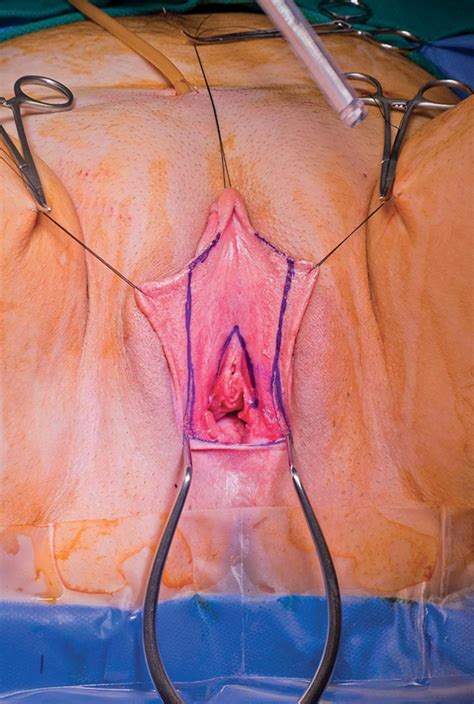 Gender Affirmation Surgery Female To Male Phalloplasty And