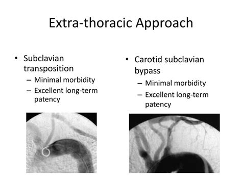 Complex Ostial Disease Of The Aortic Arch Vessels Ppt Download