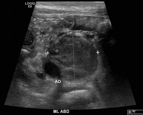 Ligation Of Common Iliac Artery Mycotic Aneurysm In A Neonate And