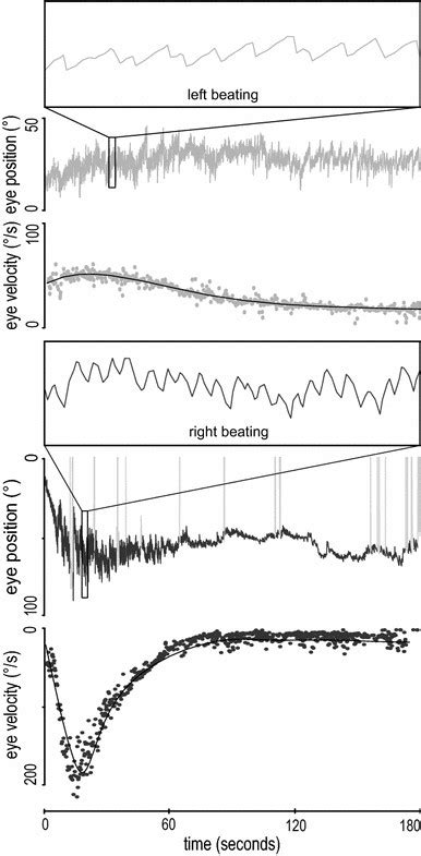 Horizontal Positional Nystagmus Recorded During The Roll Test In Download Scientific Diagram