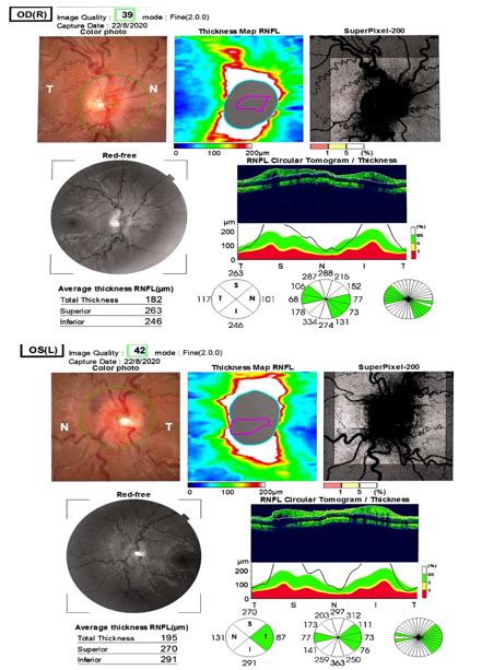 Oct Images Showing Increased Rnfl Thickness In Papilloedema Download Scientific Diagram
