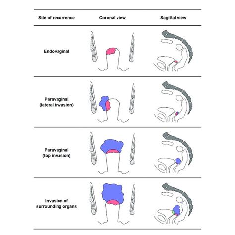 Schematic Diagram Of Recurrence Patterns Download Scientific Diagram