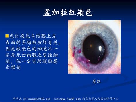 Ppt 干眼症的诊断与治疗 Powerpoint Presentation Free Download Id5446707