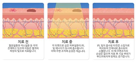 Ipl레이저 효과 가격 주의사항안보면 손해