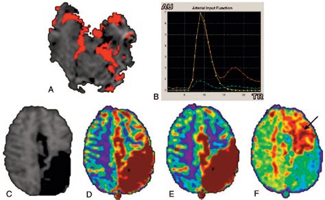 figure 1 from perfusion measurement of arterial input function