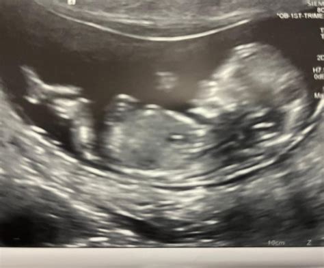 Guess The Sex Based On My Wk Scan Mumsnet