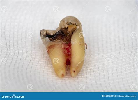 Close Up Shot Of A Decayed Molar Tooth Is Extracted The Blood Hasn T