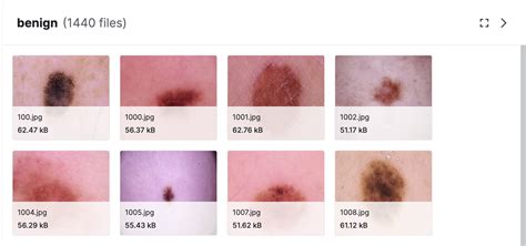 Github Yajatmittal Skin Cancer Detection