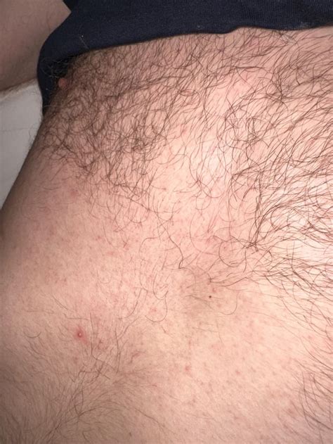 Does This Look Like Hiv Rash So Worried As Had Unprotected Sex 😢 R Hiv