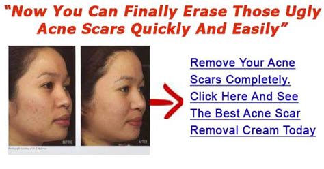 Removal Of Pimple Scars Cream For Removing Acne Scars Hints To Lose Zit Scars Easily