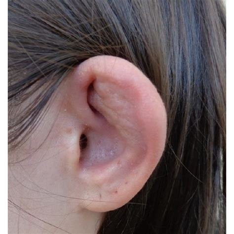 A B Cauliflower Ears Swelling And Erythema Of The Cartilaginous