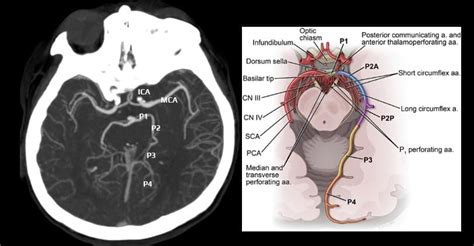 Posterior Cerebral Artery Segments 5 Vascular Abnormalities