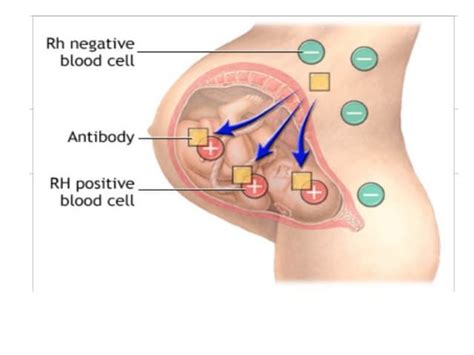 Rh Negative Pregnancy Or Rh Incompability Pptx