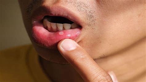 Risk Factors Of Mouth Cancer इन बातों को कभी न करें नजरअंदाज बढ़