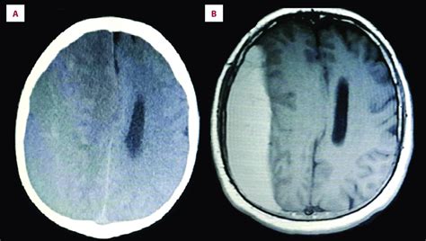 A B Preoperative Ct Scan And Magnetic Resonance Imaging Showing