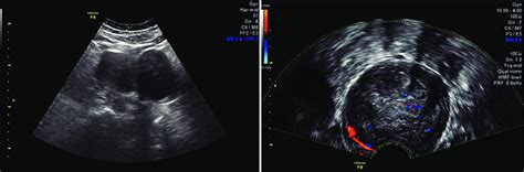 Ultrasound Showing Large Uterine Fibroid With Ring Of Fire My Xxx Hot
