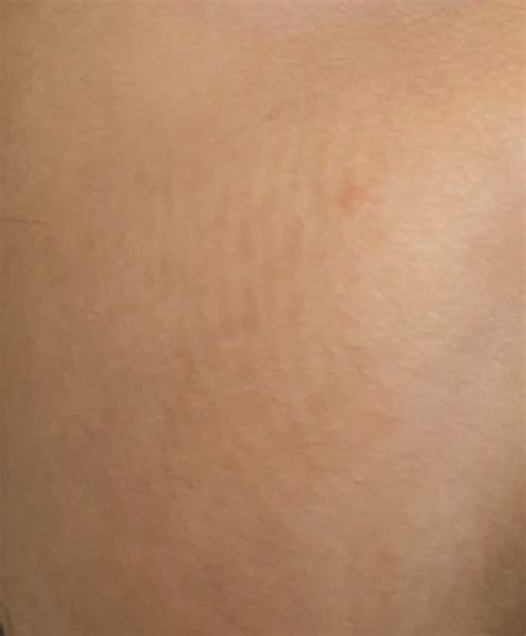 Is This Ichthyosis R Ichthyosis