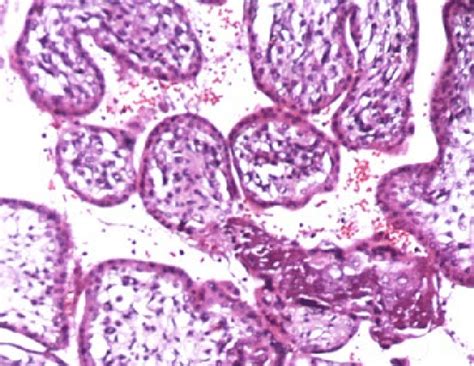 A Case Of Dande Exhibiting Normal Chorionic Villi With Covering