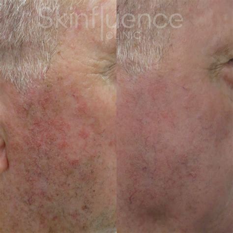 Actinic Damage Skinfluence Clinic