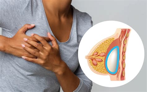 Capsular Contracture Solutions Expert Medical Insights Ck Health Turkey