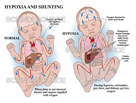 Photograph Hypoxia And Shunting Artwork Science Source Images