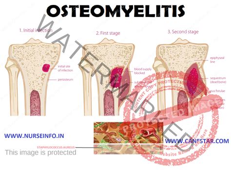 Management Of Chronic Osteomyelitis Of The Femur And Tibia A