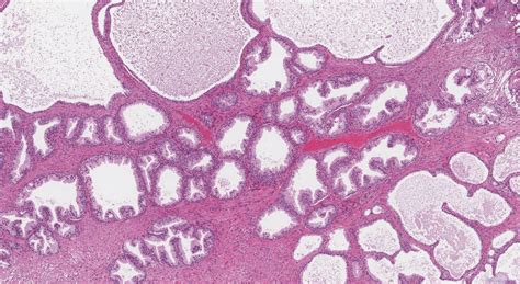 Benign Prostatic Hyperplasia Ottawa Atlas Of Pathology