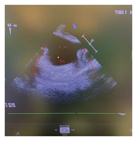 Tee Bicaval View Demonstrating A Patent Ivc Without Thrombus Download Scientific Diagram