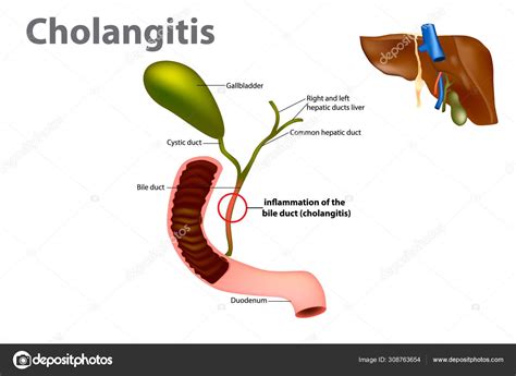 Entzündung Des Gallengangs Aufsteigende Cholangitis Oder Akute Cholangitis Stock Vektorgrafik