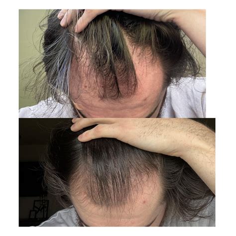 Diffuse Thinning R Hairtransplants