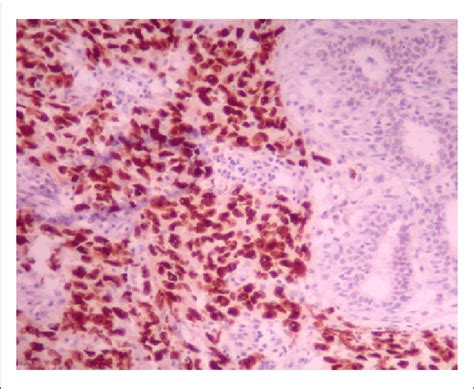 Benign Phyllodes Tumor Expression Of Stromal Cd34 100× Figure 6 Download Scientific
