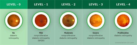 Diabetic Retinopathy Brain Station 23 Talent Your Service