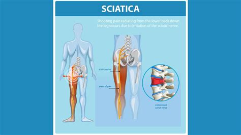 साइटिका और कमर के दर्द में अंतर Difference Between Sciatica And Back
