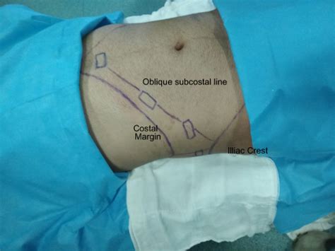 Anesthetic Techniques Focus On Transversus Abdominis Plane Tap Bloc Lra Dove Medical Press