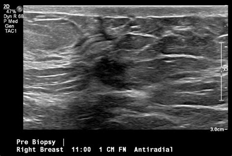 Partial Mastectomy Lumpectomy Utilizing Savi Scout For A Nonpalpable Papilloma Journal Of