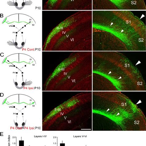 Callosal Projection Is Affected By Unilateral But Rescued By Bilateral