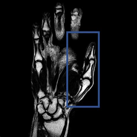 Mri Masters Thumb Mri Thumb Planning Pekb