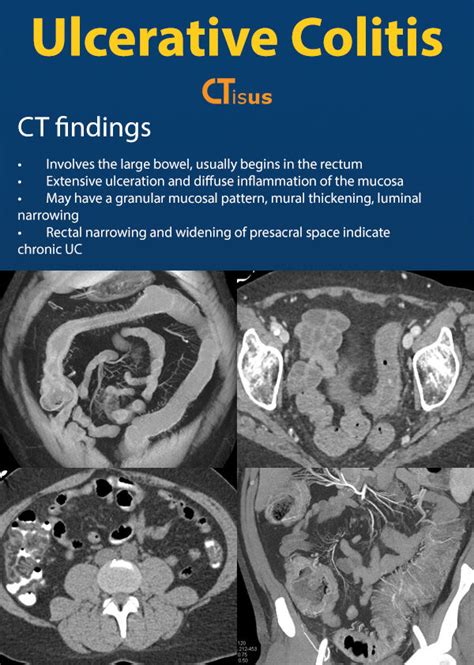 Ulcerative Colitis Ct Findings Ctisus
