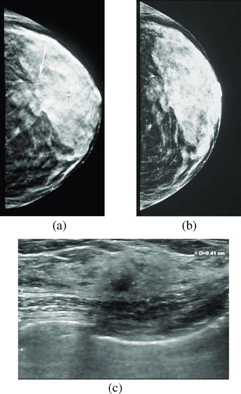 Thirty Five Years Old Female Underwent Right Sided Lumpectomy For Download Scientific Diagram