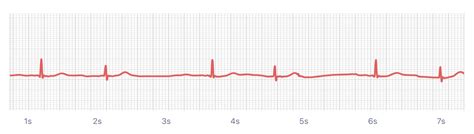 What Second Degree Av Block Type 1 Wenckebach Looks Like On Your