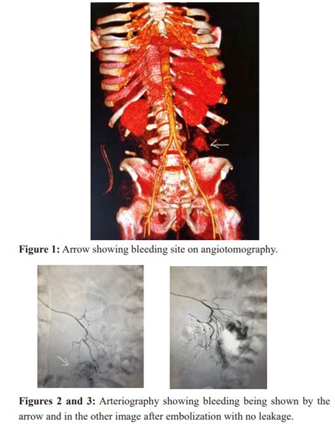 Lower Gastrointestinal Bleeding Treated With Super Selective Arterial Embolization A Case Report