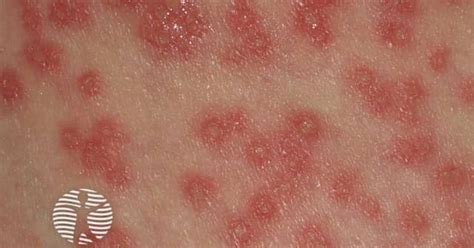 Eczema Herpeticum Chicken Pox At Patrick Drago Blog