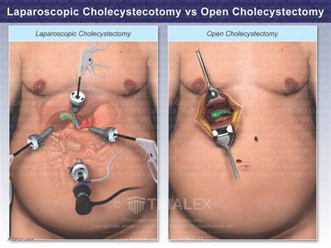 Laparoscopic Cholecystectomy