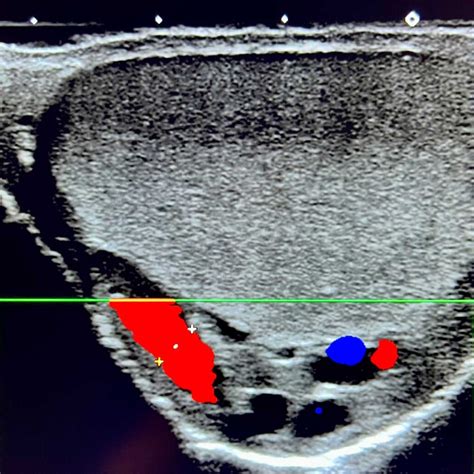 Varicocele Embolisation Pelvic Congestion Syndrome Dr Crowe